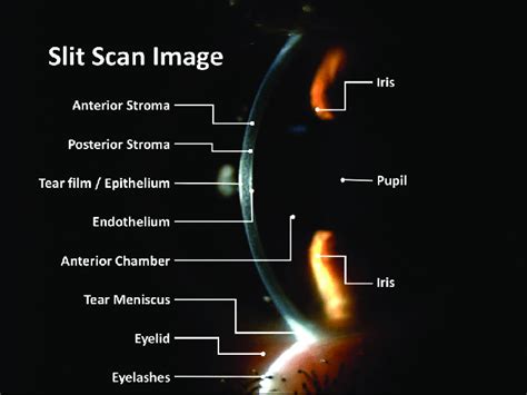 Corneal Parallelepiped