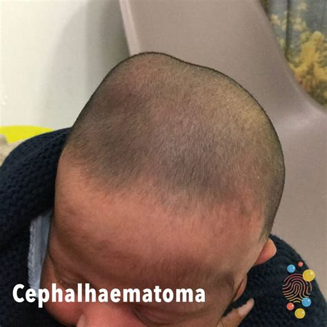 Cephalohematoma Healing Process