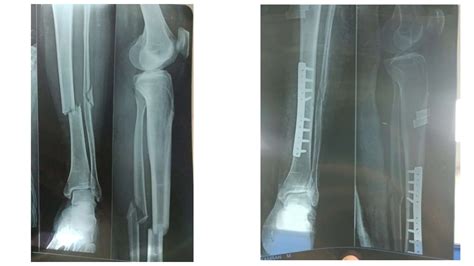 Emergency Department Bone Fracture Management Ppt