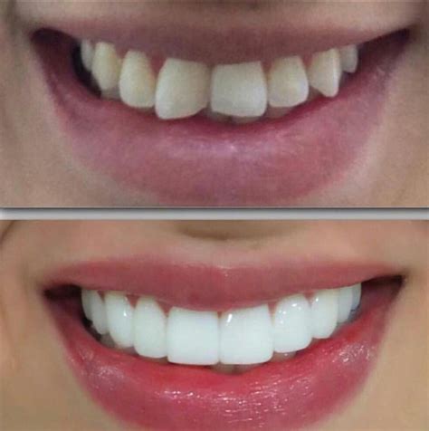Porcelain Veneersdental Veneers Colombia