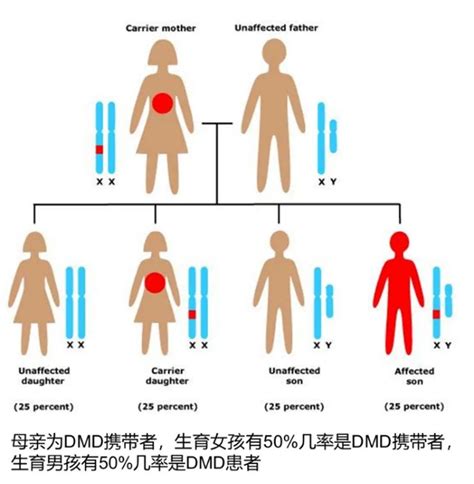 基因解 遗” ‖ 一文认识 传男不传女”的遗传病——杜氏肌营养不良 知乎
