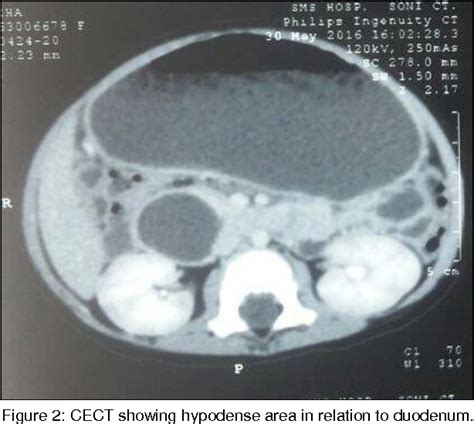 Figure 1 From Foreign Body In Duodenum Mimicking A Duplication Cyst On