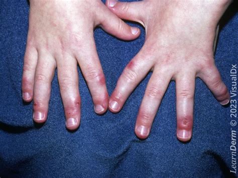 Acral Learnderm