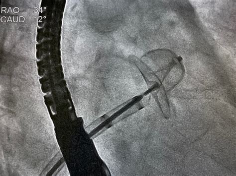 Left Atrial Appendage Closure Devices Effective At Preventing Stroke In Very Elderly Patients