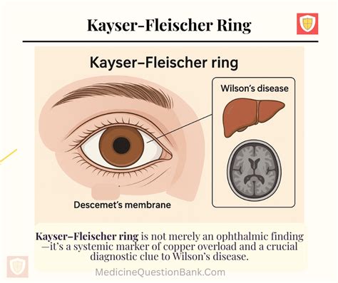 Kayser Fleischer Ring Medicine Question Bank