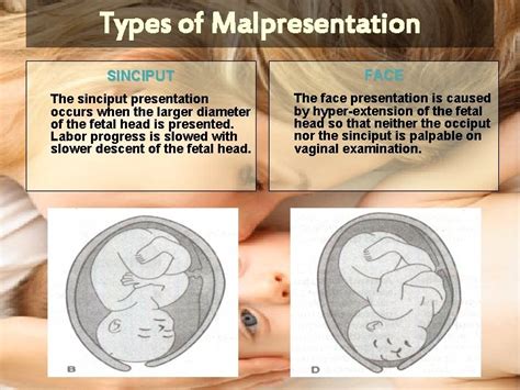 Types Of Malpresentation Transverse In A Transverse Lie