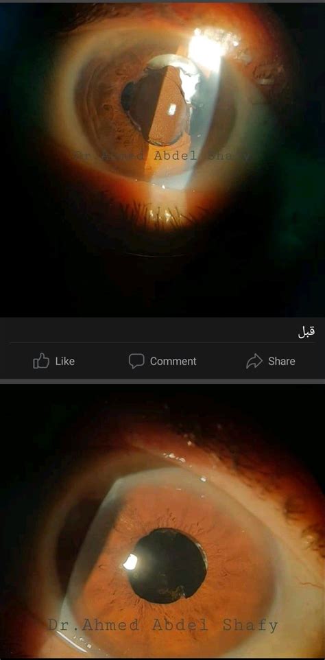 ahmed abdelshafy tabl on linkedin aphakia and pupillary membrane