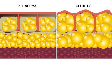 Celulitis Edematosa Qué Es Síntomas Causas Y Tratamiento