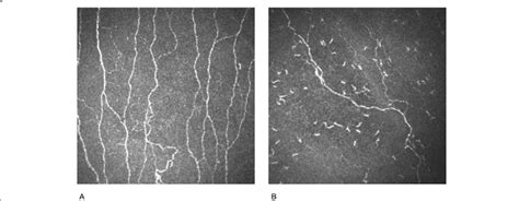 Corneal Confocal Microscopy Showing Nerve Fiber Reduction And Immune