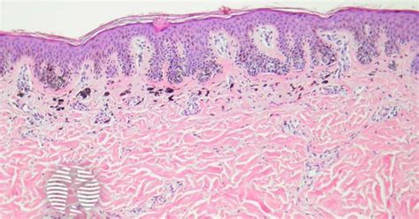 Lentiginous Naevus Pathology Image