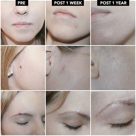 Mole Removal Usha Rajagopal Md
