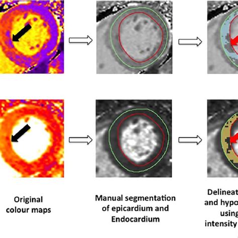 Semiautomated Method Used To Identify The Hypointense Core On The T 1 Download Scientific