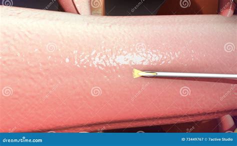 Spinal Anaesthesia Stock Image Image Of Back Cesarean 73449767