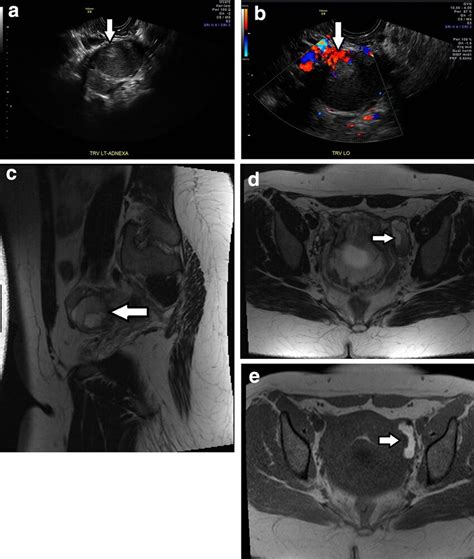 Decidualized Endometrioma In A 29 Year Old Pregnant Female In The First Download Scientific