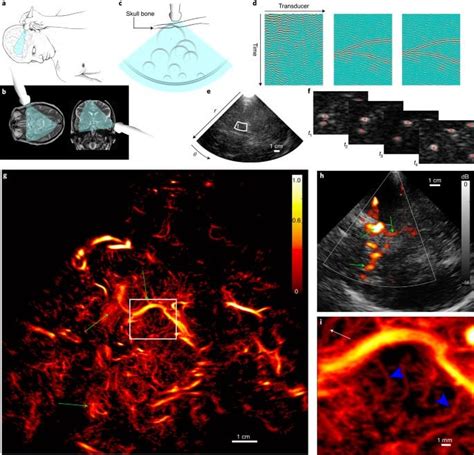 Transcranial Ultrafast Ultrasound Localization Microscopy Of Brain