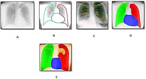 Figure 2 From Convolution Denoising Regularized Auto Encoder Stacked