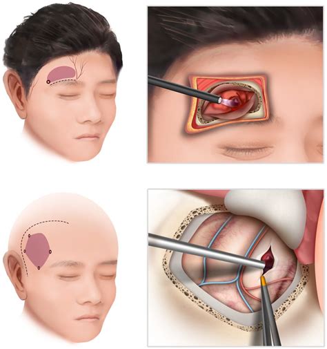 Facial Hematoma Evacuation Subdural Hematoma Surgery Background