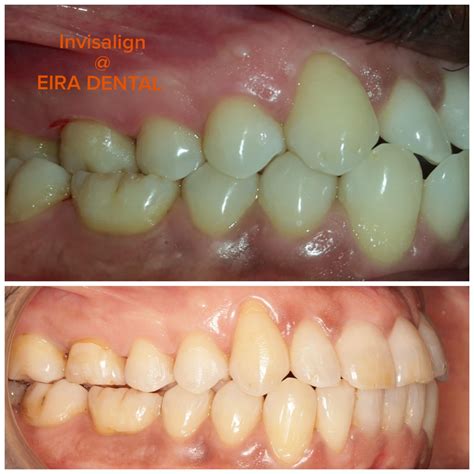Understanding Crossbites Anterior And Posterior
