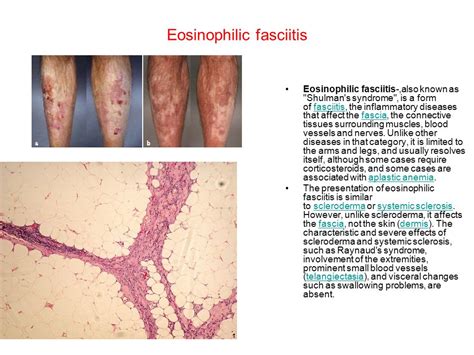 Localized Scleroderma Ppt Download