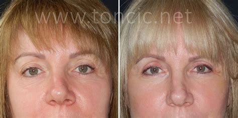 Blefaroplastika Poliklinika Dr Tončić