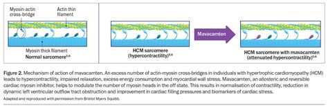 Mavacamten A Novel Treatment For Obstructive Hypertrophic Cardiomyopathy Medicine Today