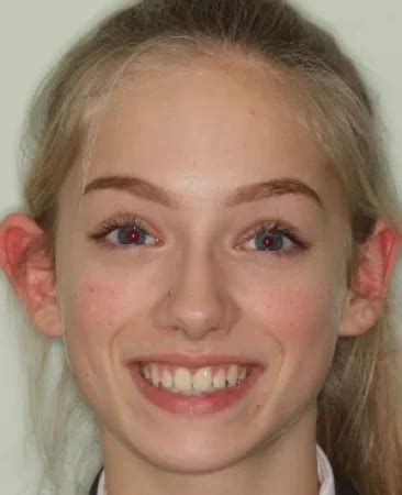 Diastema Treatment Gaps Between Teeth Closed With Damon Braces