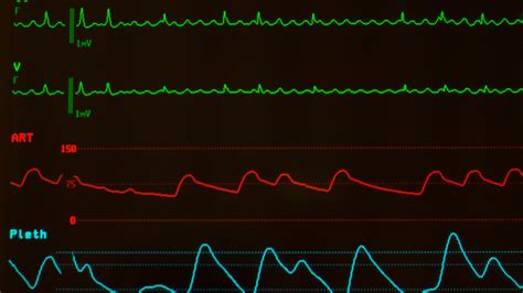 Atrial Flutter Classification Causes Ecg Diagnosis And Management