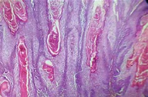 Epithelium Showing Exophytic And Endophytic Growth With Parakeratin Download Scientific Diagram