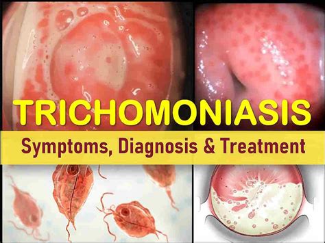 Trichomoniasis Trich Causes Symptoms Diagnosis And Treatment