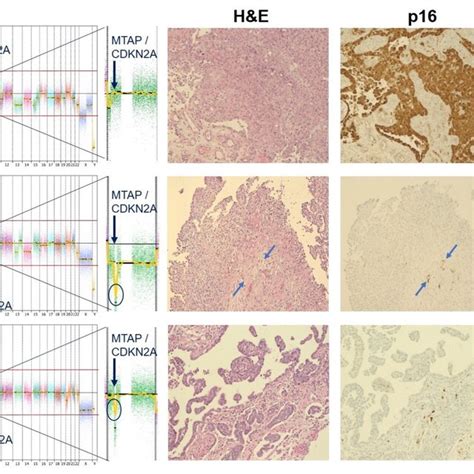 Cnv Profiles And Ihc Staining Patterns Of P16 And Mtap In A Case With