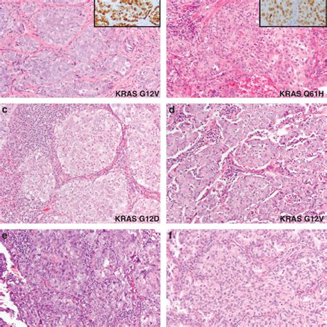 Summary Of Mutations In 180 Lung Adenocarcinomas Download Table