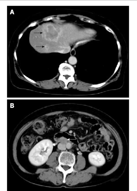 Figure 1 From A Case Of Advanced Intrahepatic Cholangiocarcinoma Successfully Treated With