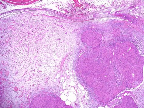 Neural Proliferation With Hybrid Tumor Pattern In Which Diffuse Areas Download Scientific