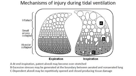 Recruitment Maneuvers In Ards Pptx