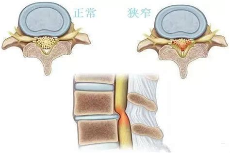 腰椎管狭窄如何分类？按疾病类型可分为两大类 治疗 进行 脊神经