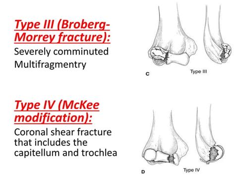 Capitellum Fractures Ppt