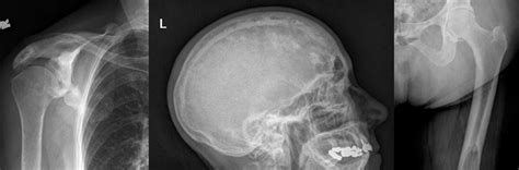 Pagets Disease Causes Types Symptoms Diagnosis And Treatment