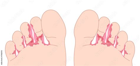 Foot Fungus Bacteria Toe Itchiness With And Jock Itch Symptom Smell Bad