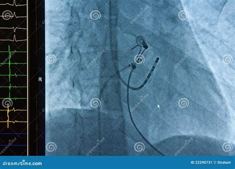 Catheter Ablation For Atrial Fibrillation Stock Image Image Of Controls Chest 22290731