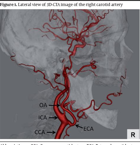 Internal Carotid Artery Angiogram