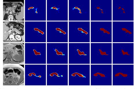 Figure 8 From Pancreas Segmentation In Ct And Mri Images Via Domain Specific Network Designing