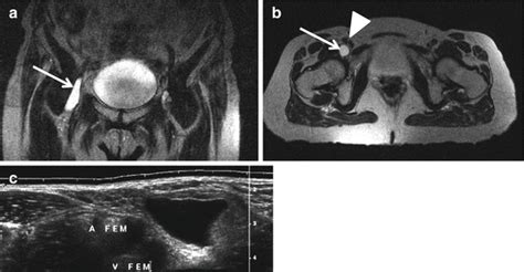 Iliopsoas Bursitis Mri