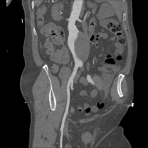 Pre Operative CT Scan With Curvilinear Reconstruction Showing An Download Scientific Diagram
