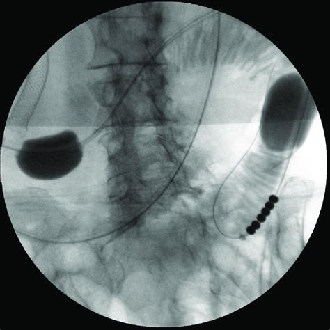 Fluoroscopy Visualization Of The Double Balloon Catheter Positioned