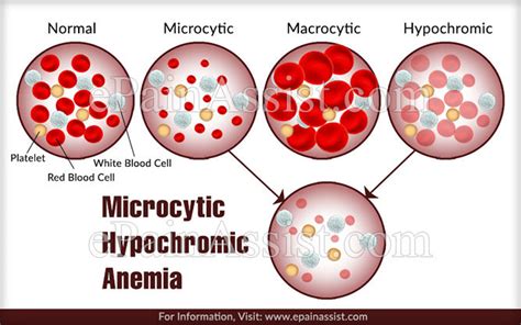 What Is Microcytic Hypochromic Anemiacausessymptomstreatment