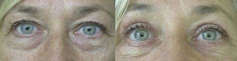Female Looking Straight Ahead Before And After Blepharoplasty Surgery