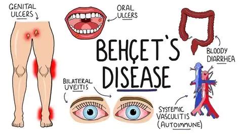 Health Lines Behçets Disease Causes Symptoms Diagnosis And Treatment