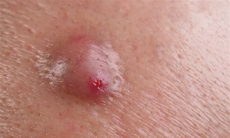 How Laser Hair Removal Works For Ingrown Hair Prone Skin London