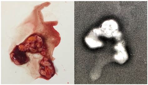 VAB Specimen Picture And Mammogram Image VAB Indicates Download Scientific Diagram