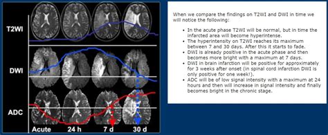 Diagnosis Of Dwi Negative Acute Ischemic Stroke Ysreg